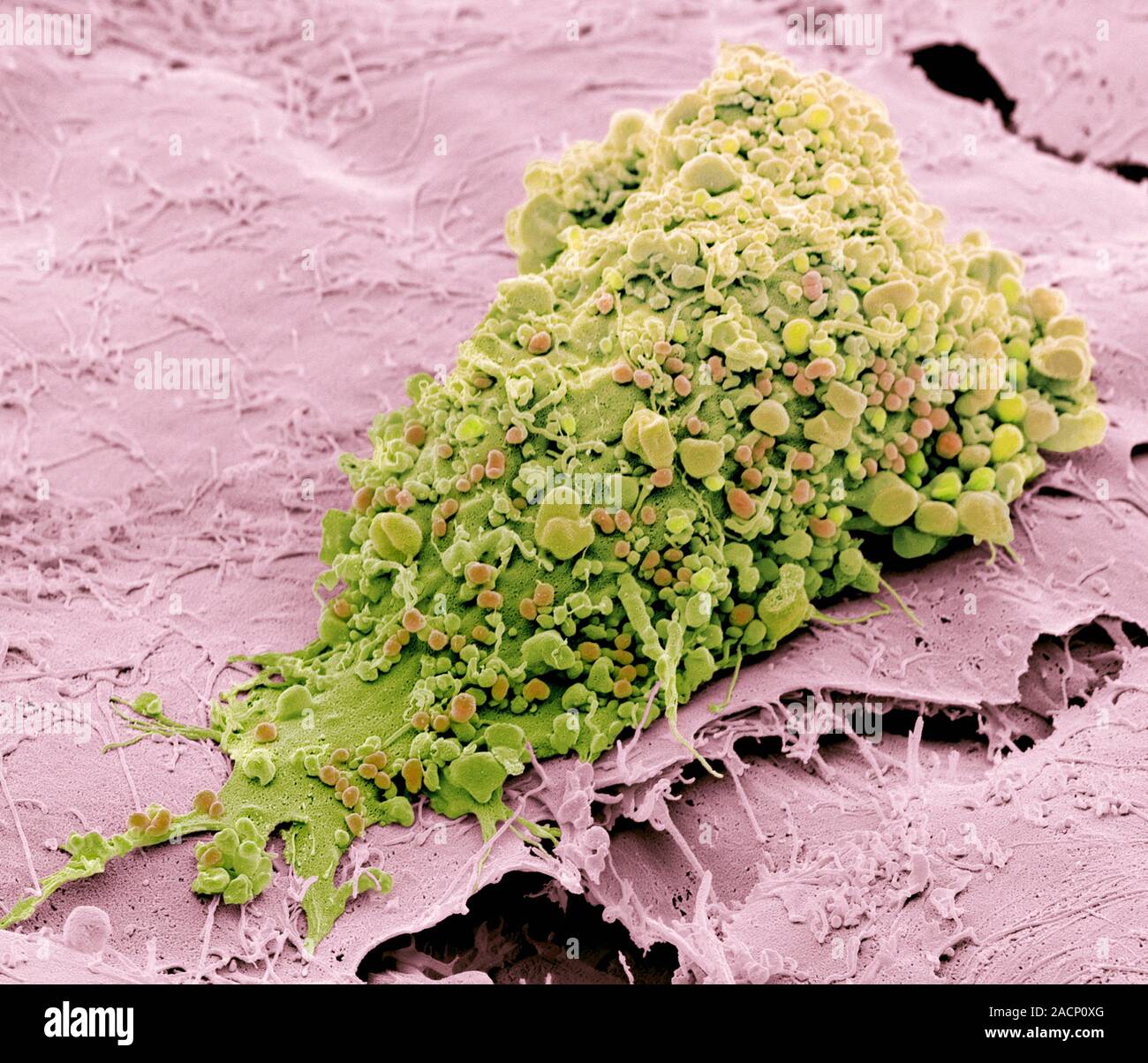 Bone cancer cell. Coloured scanning electron micrograph of an ...
