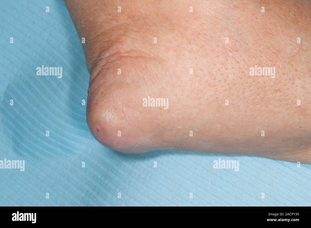 Bursitis of the elbow. View of the inflamed elbow (olecranon) of a 75 ...