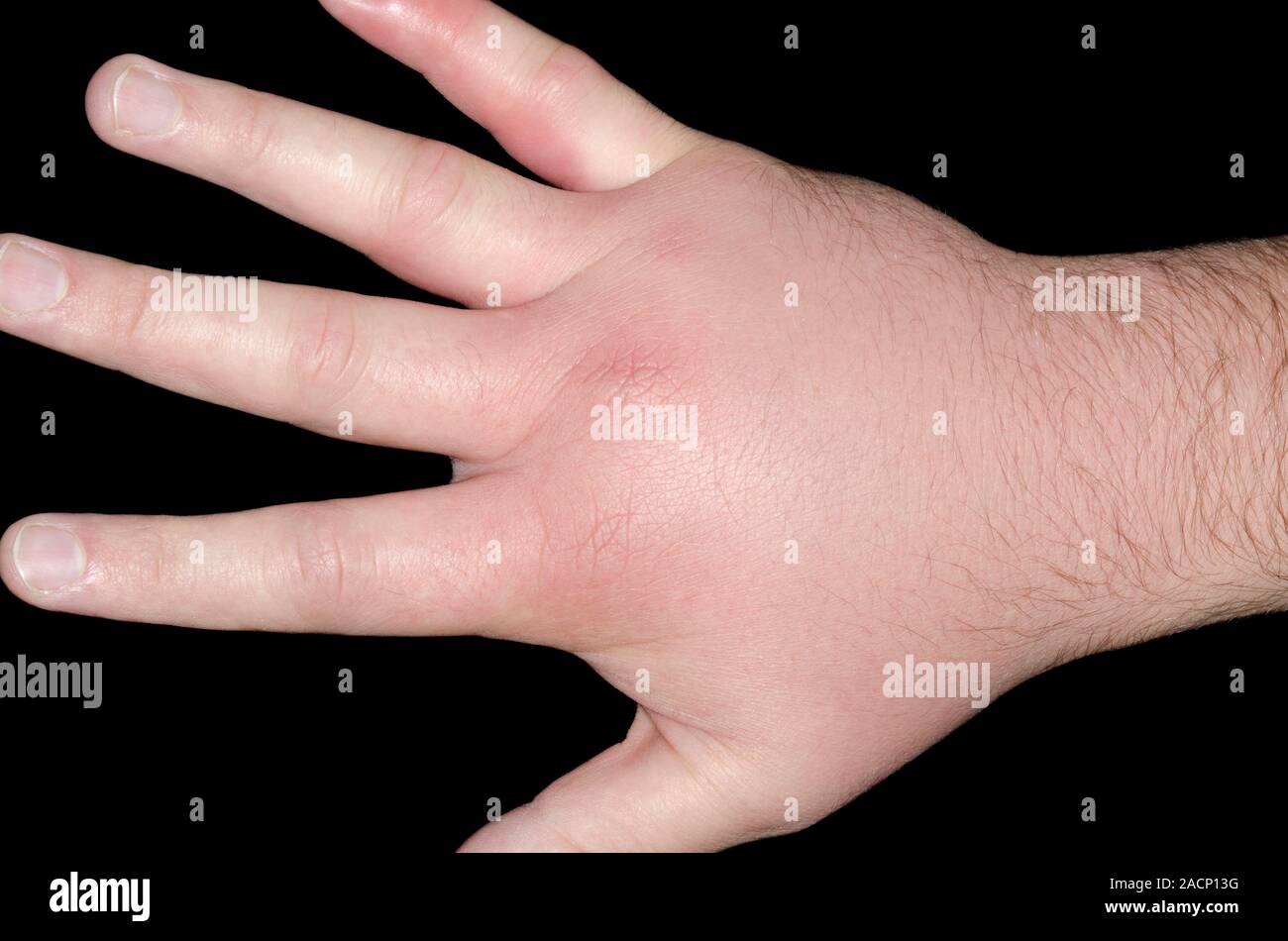 Cellulitis of the hand. Close-up of the swollen hand of a 35-year-old ...