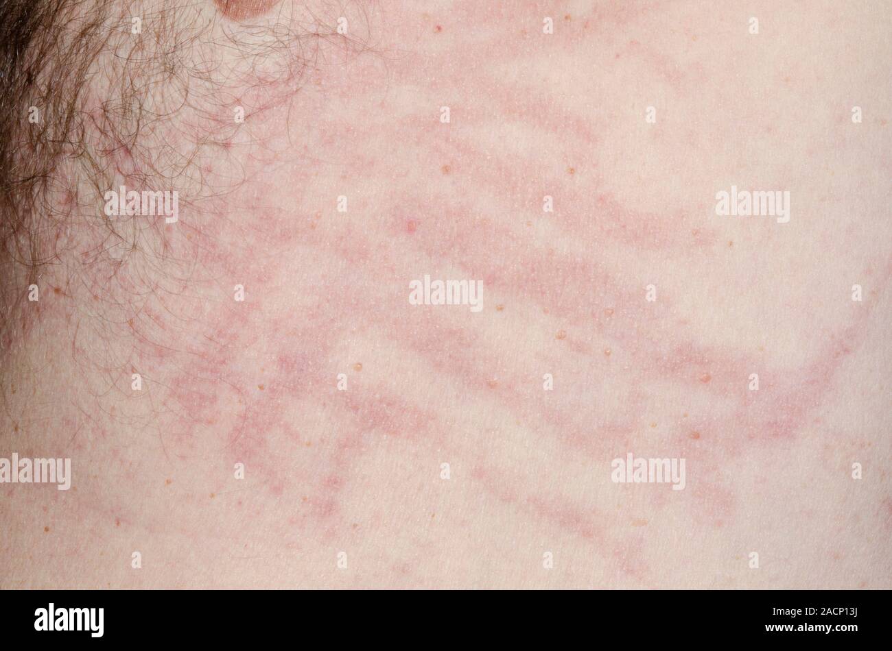 Urticaria. Red rash (hives) and scratches on the skin of a 48-year-old ...