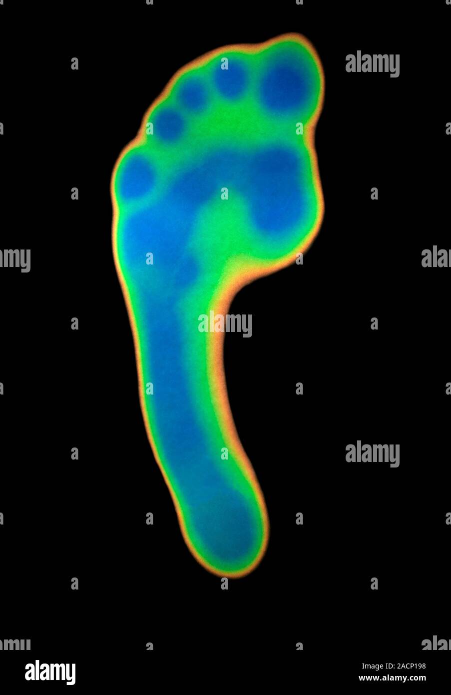 Foot, thermogram. Thermography records surface temperatures by ...