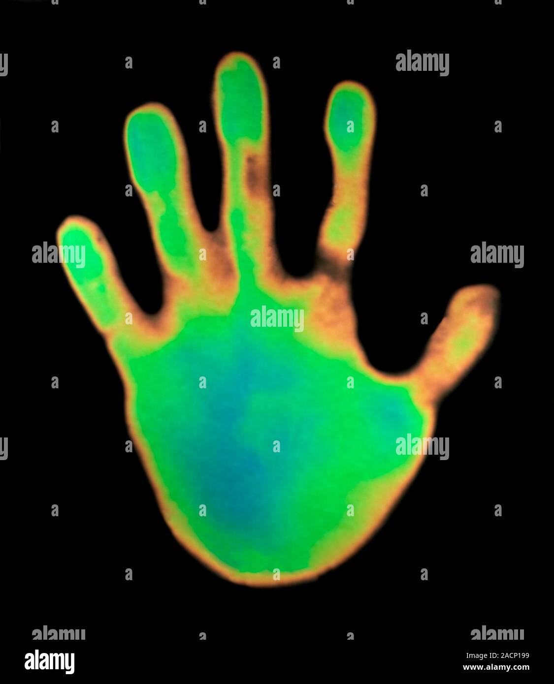 Hand, thermogram. Thermography records surface temperatures by ...