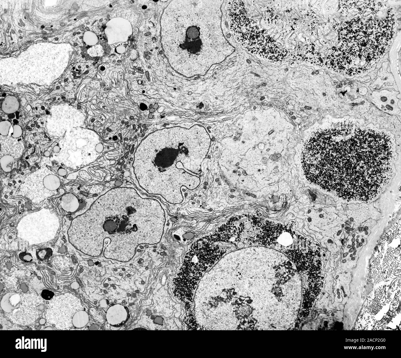 Testicular Cancer Transmission Electron Micrograph Tem Of A Section