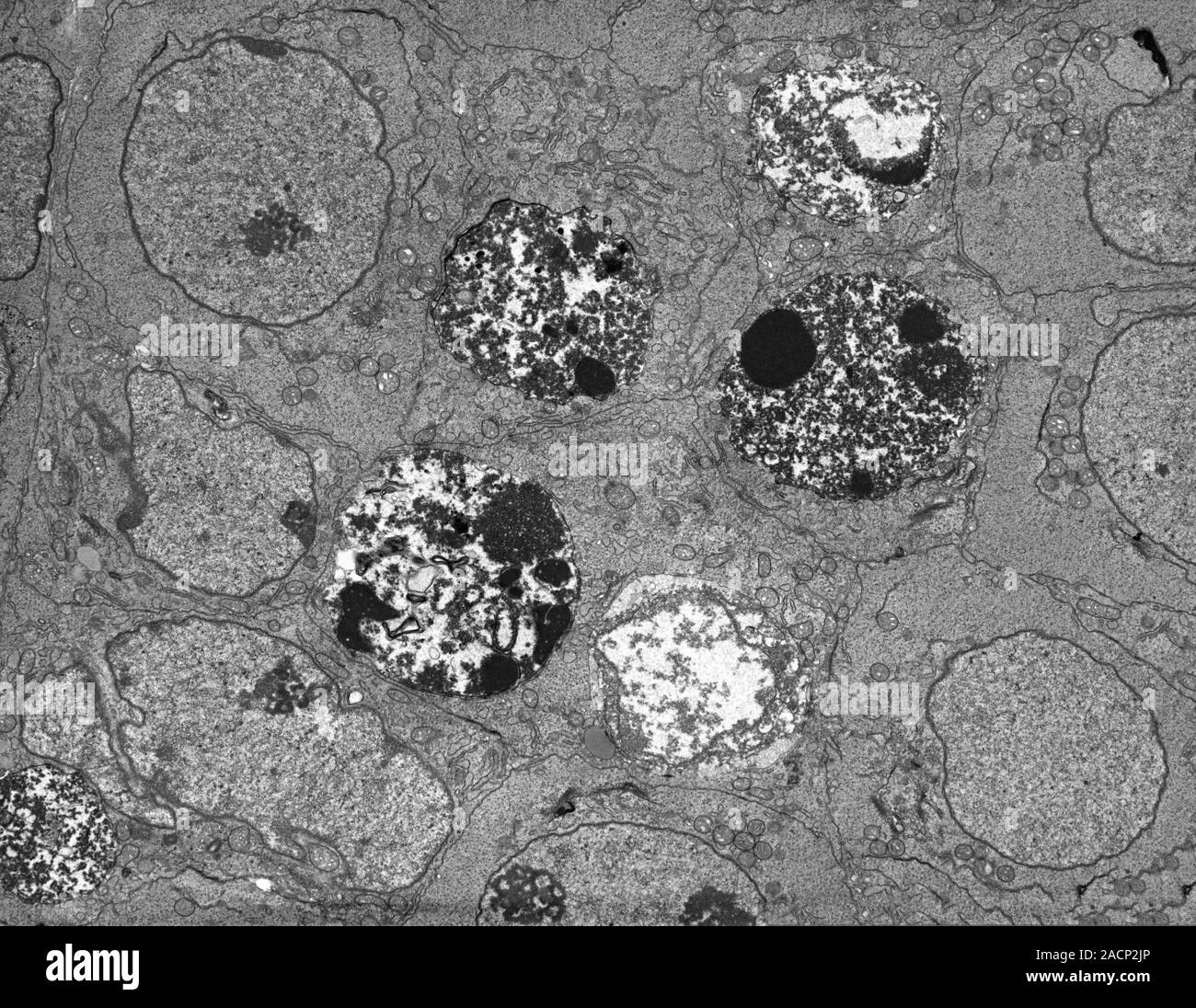 Apoptosis cell death. Transmission electron micrograph (TEM) of a ...