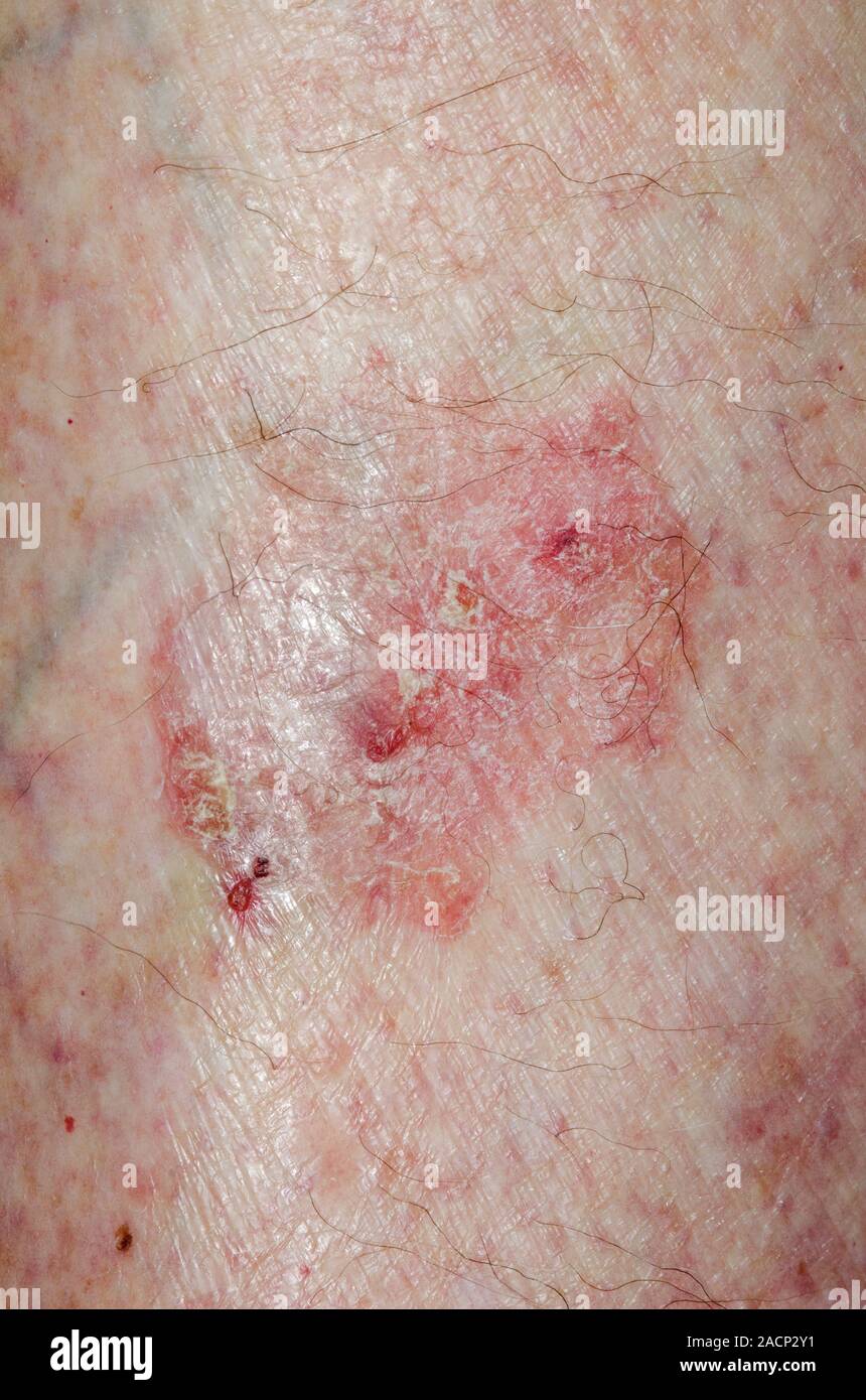 Close-up of a skin lesion on the shin of the leg in an 82 year old ...