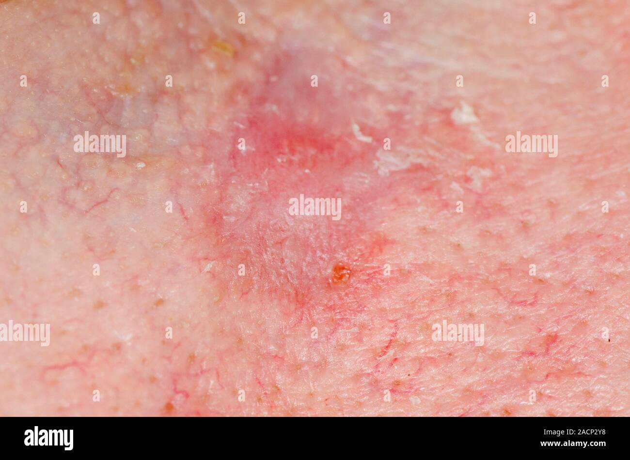 Close Up Of A Healed Basal Cell Carcinoma Bcc Or Rodent Ulcer On The Skin Of The Cheek In A