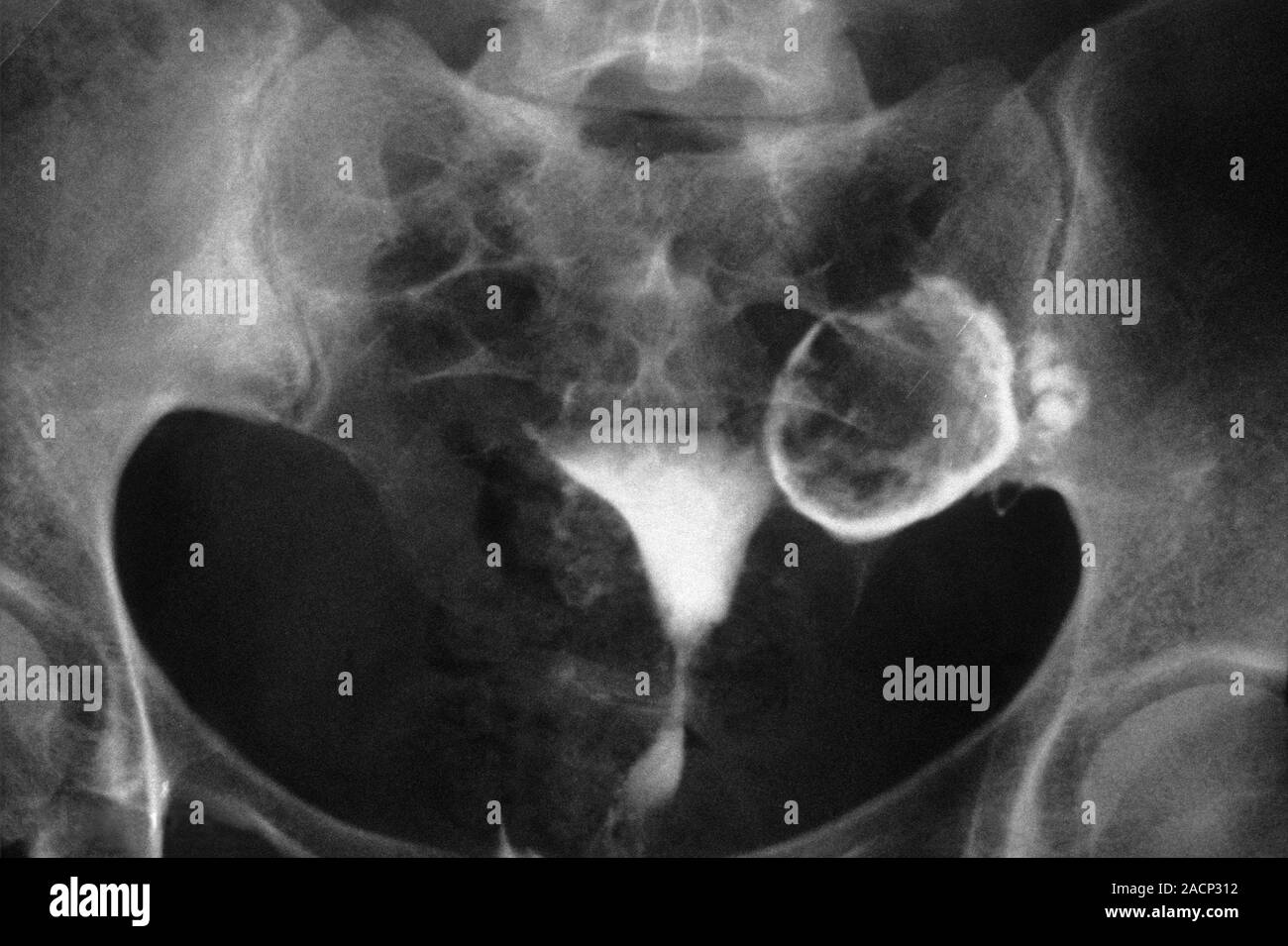 Pelvic X-ray (hysterosalpingography) in front view showing an ectopic ...