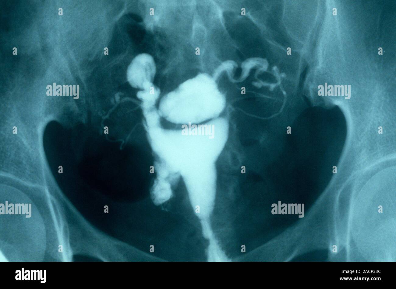 Pelvic X-ray (hysterosalpingography) in front view showing the uterus ...