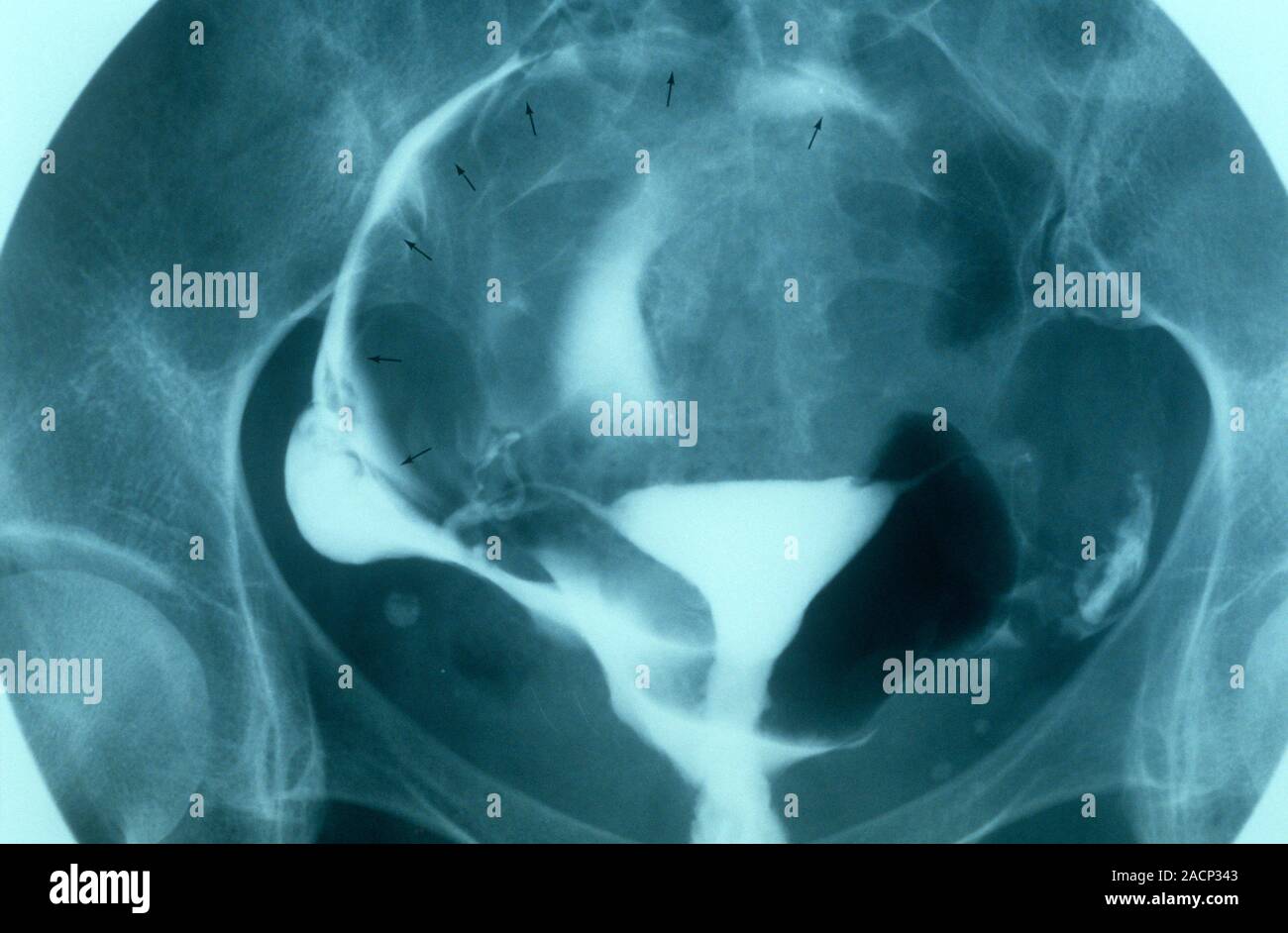 Pelvic X-ray (hysterosalpingography) in front view showing the uterus ...