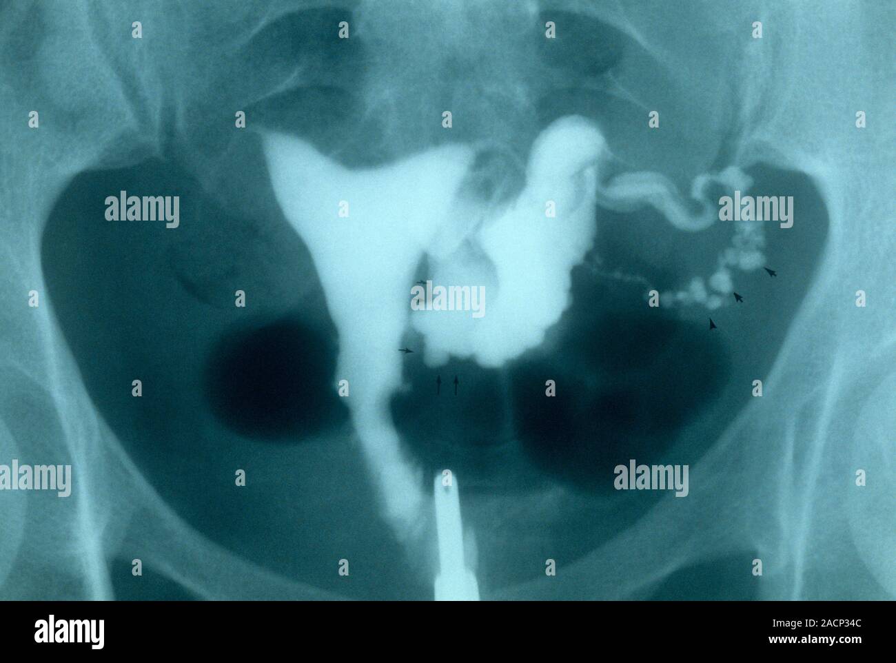 Pelvic X-ray (hysterosalpingography) in front view showing the uterus ...
