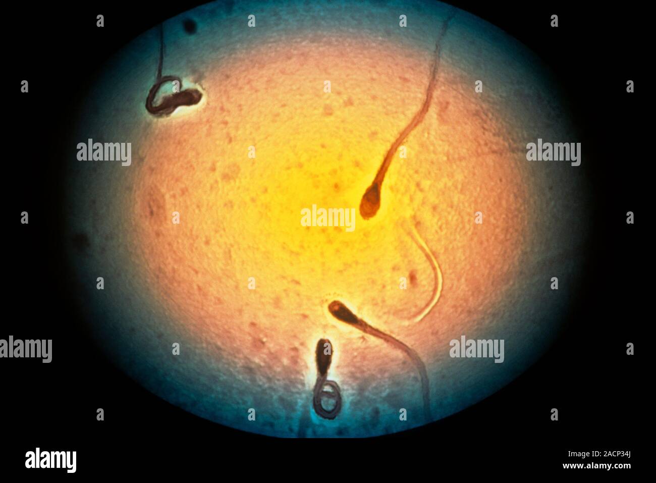 Light micrograph of normal and atypical (rolled) human sperm Stock ...