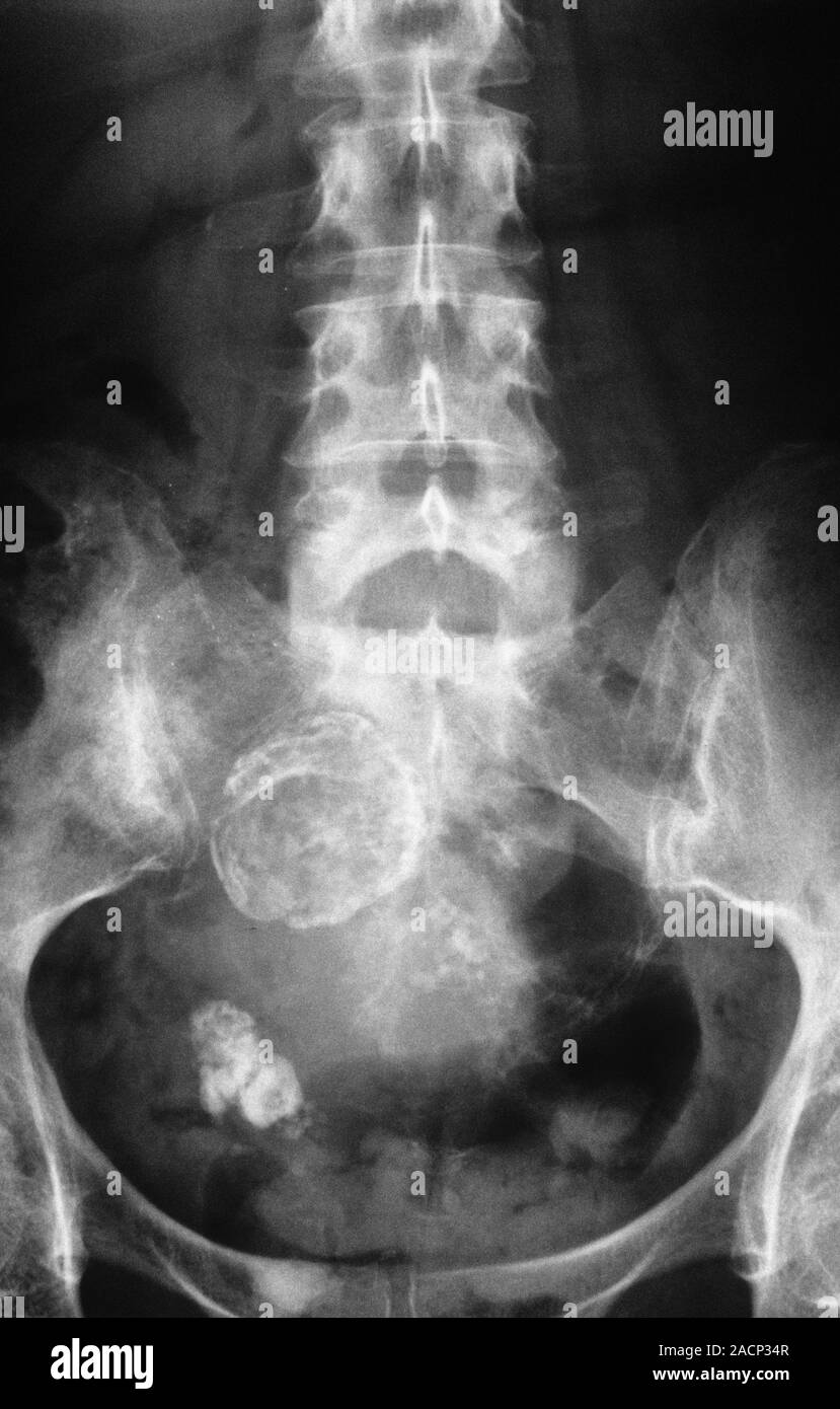 Pelvic X-ray (front view) showing calcified cysts in a woman's ovary ...