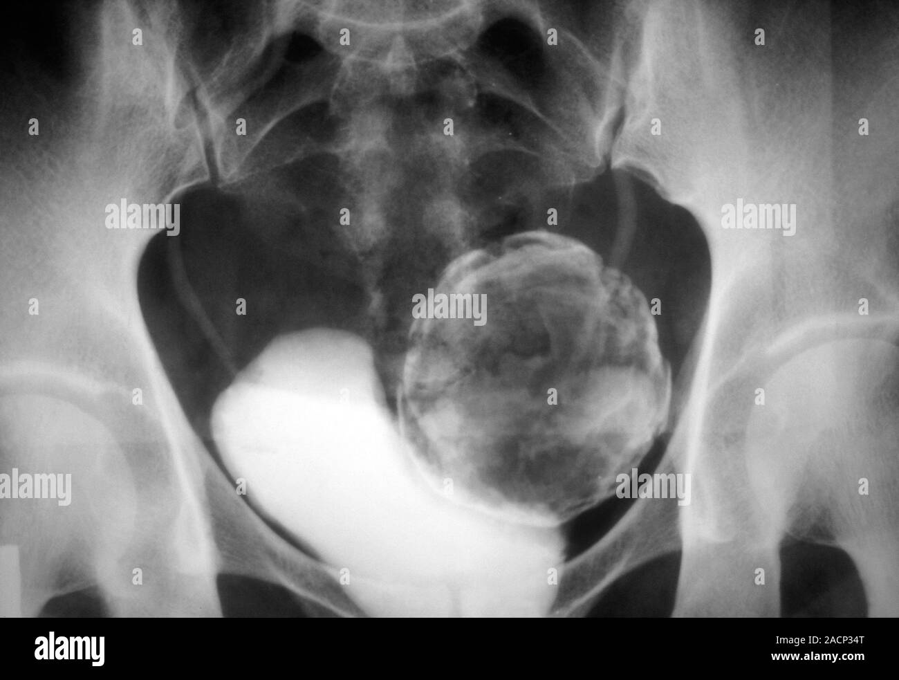 Pelvic X-ray (front view) showing a large calcified fibroid (rounded ...