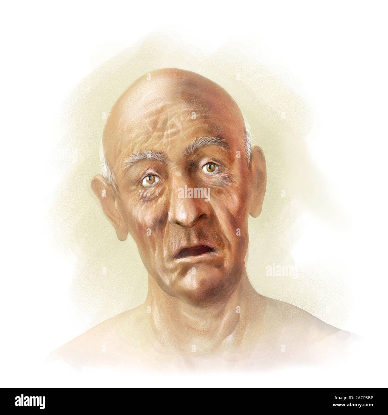 Alzheimer's disease. Artwork of the face of an elderly male patient ...