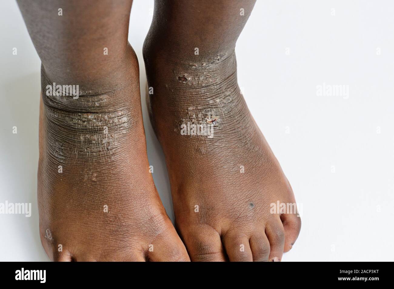 Not for use in Television Not for use in Television Eczema on the skin ...