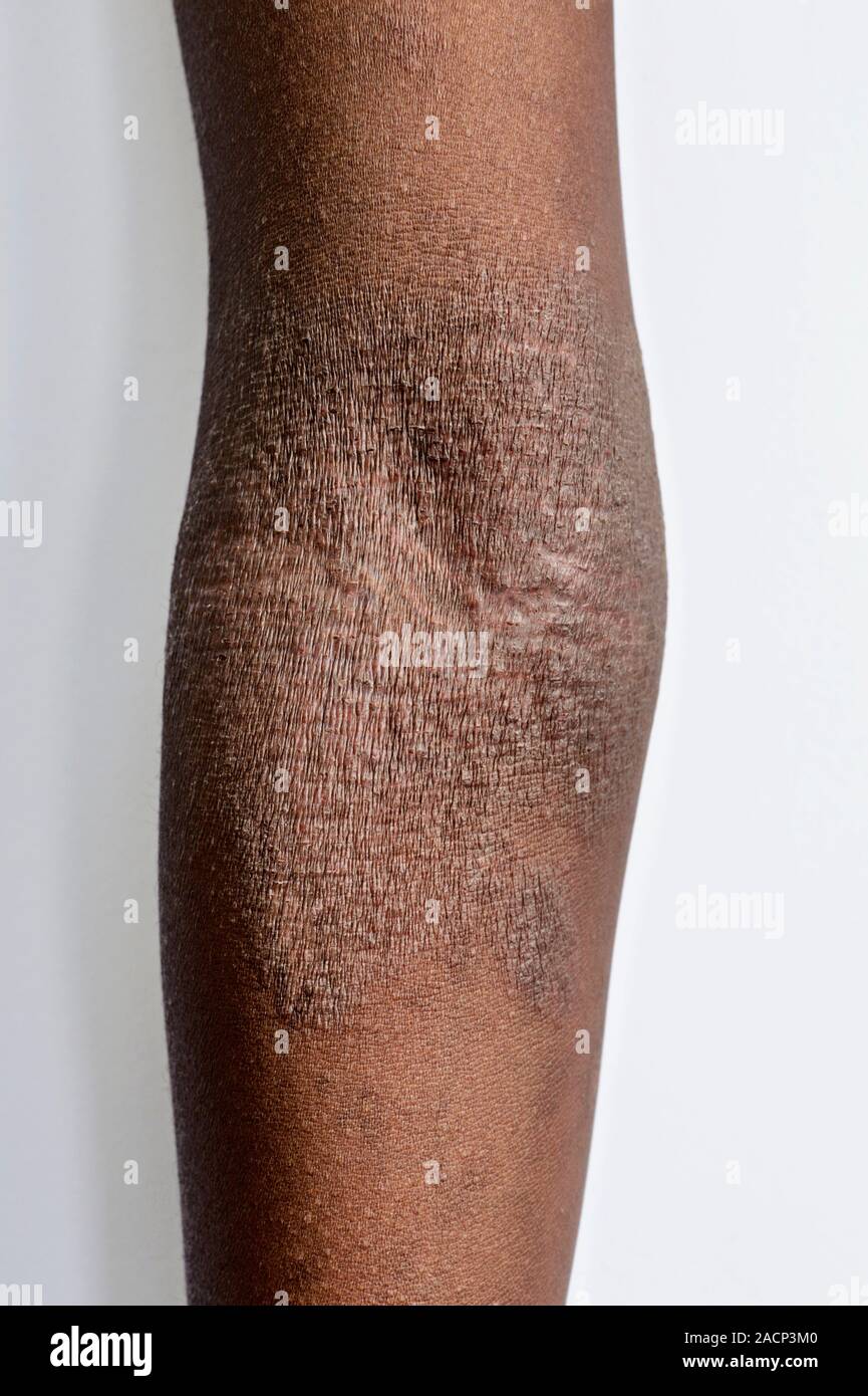 Not For Use In Television Not For Use In Television Eczema On The Skin Of The Elbow In An