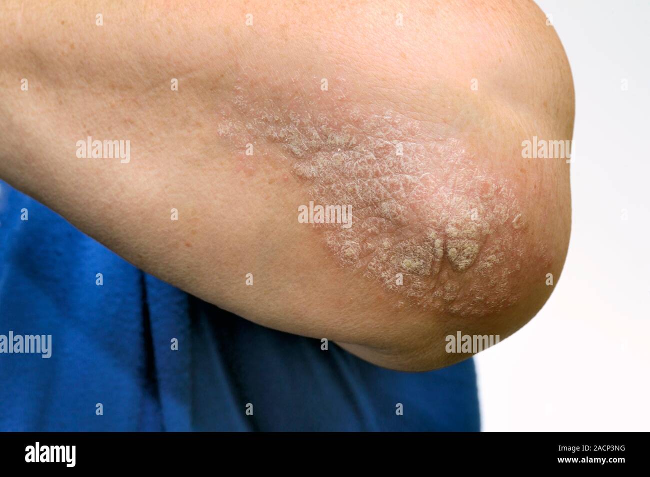 Not for use in Television Not for use in Television Patch (plaque) of ...