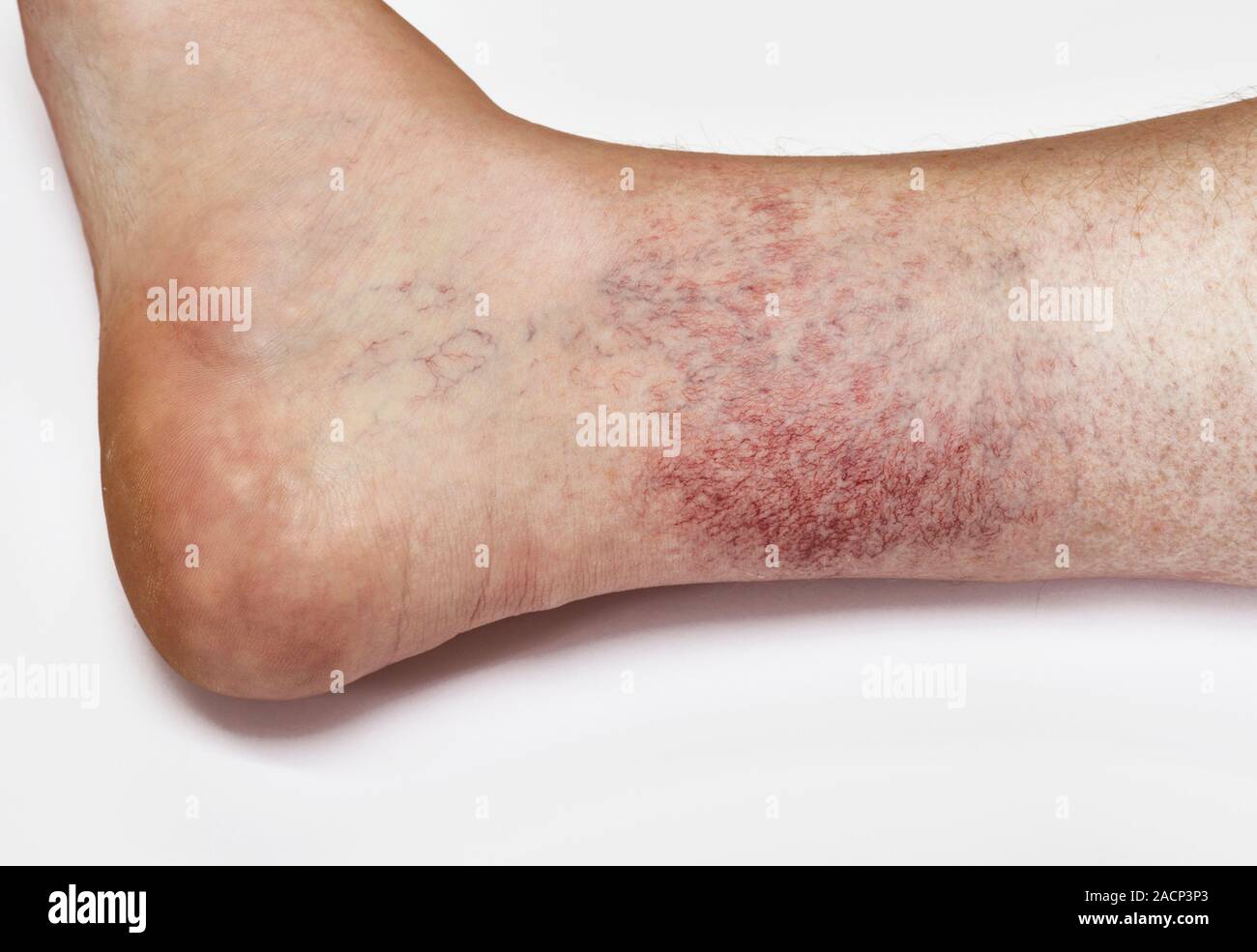 Not for use in Television Not for use in Television Enlarged blood ...
