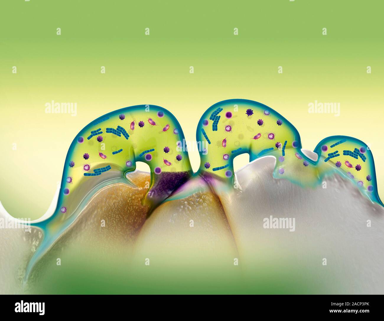 Tooth decay. Computer artwork of a human tooth, showing a cavity (decay ...