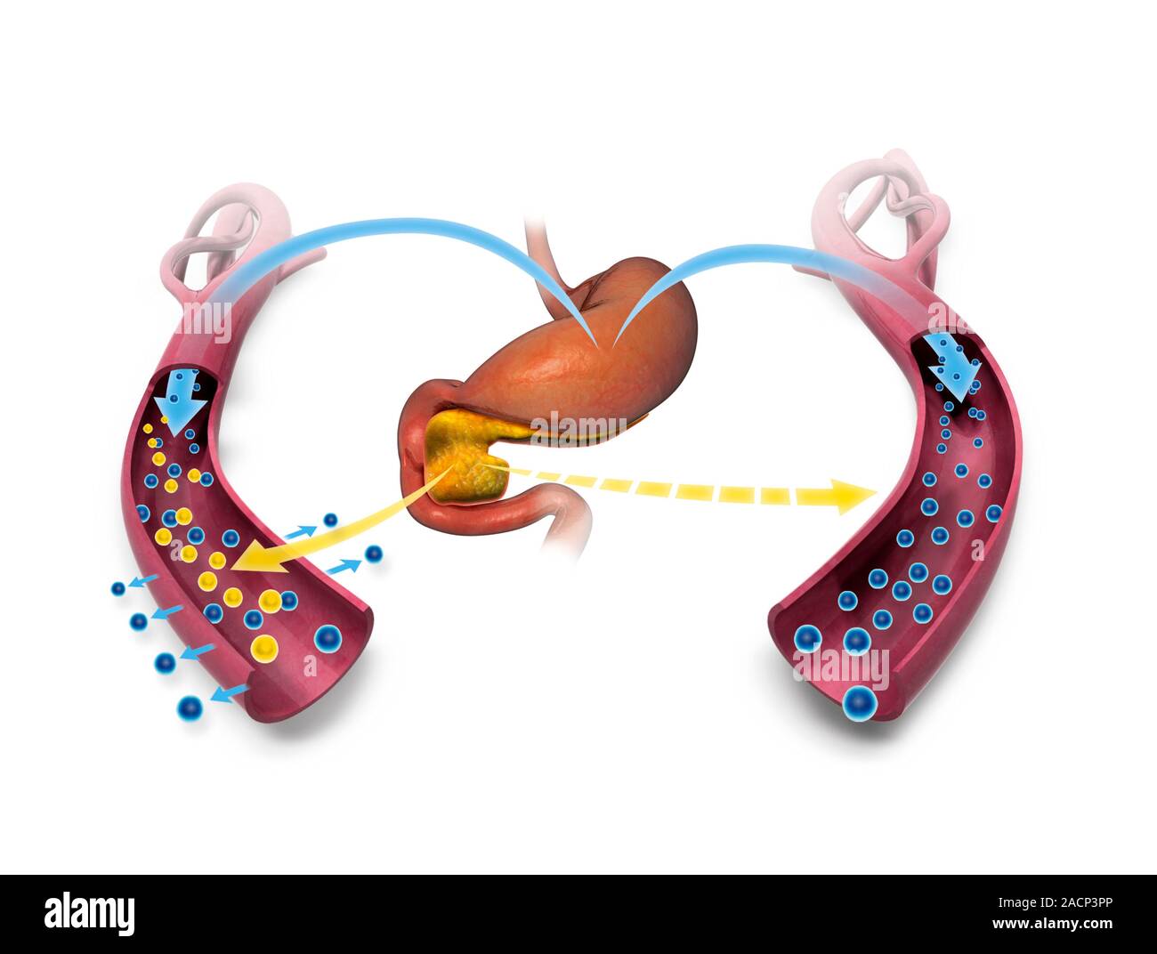 Diabetes. Computer artwork showing the difference between a diabetic ...