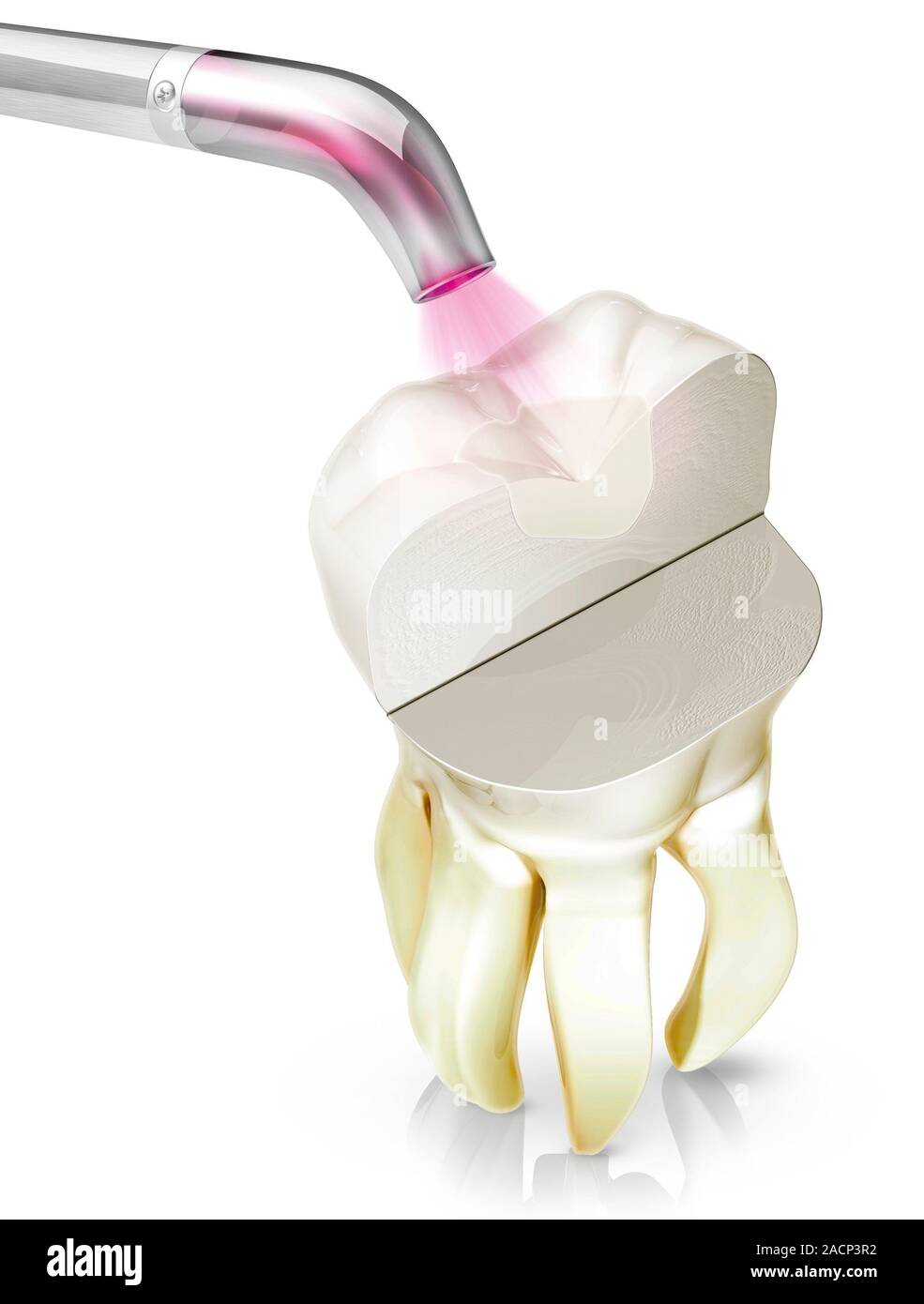 Light-reactive dental filling. Computer artwork showing a blue light ...