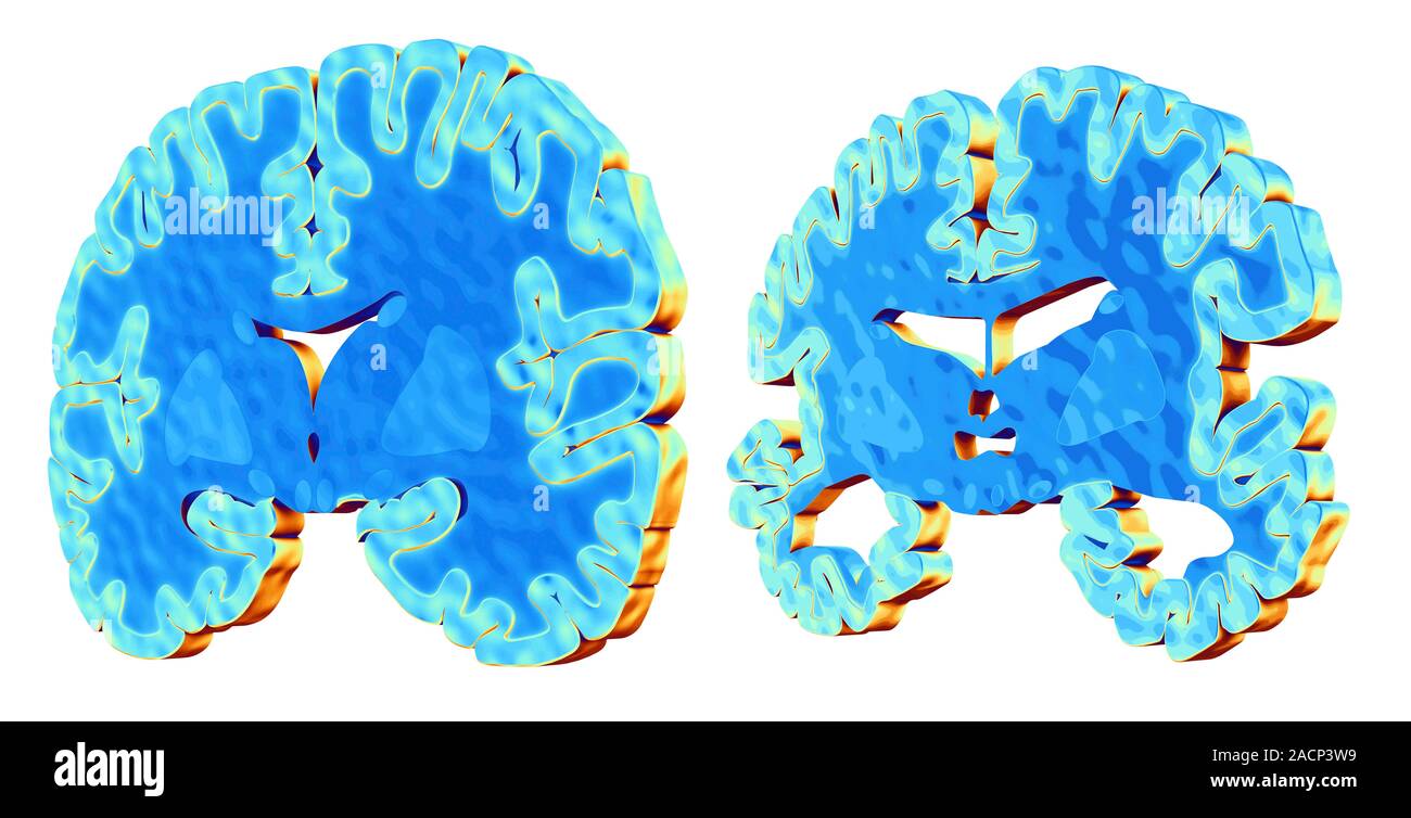 Alzheimer's disease. Computer artwork of coronal (vertical) slices ...