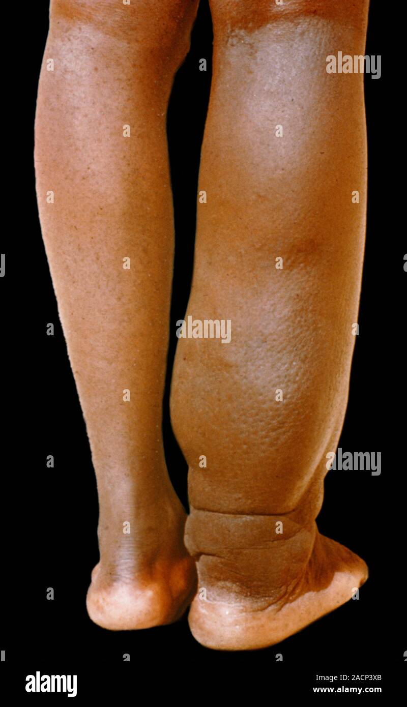 Elephantiasis Youtube Elephantiasis – What Is It And What Help Is