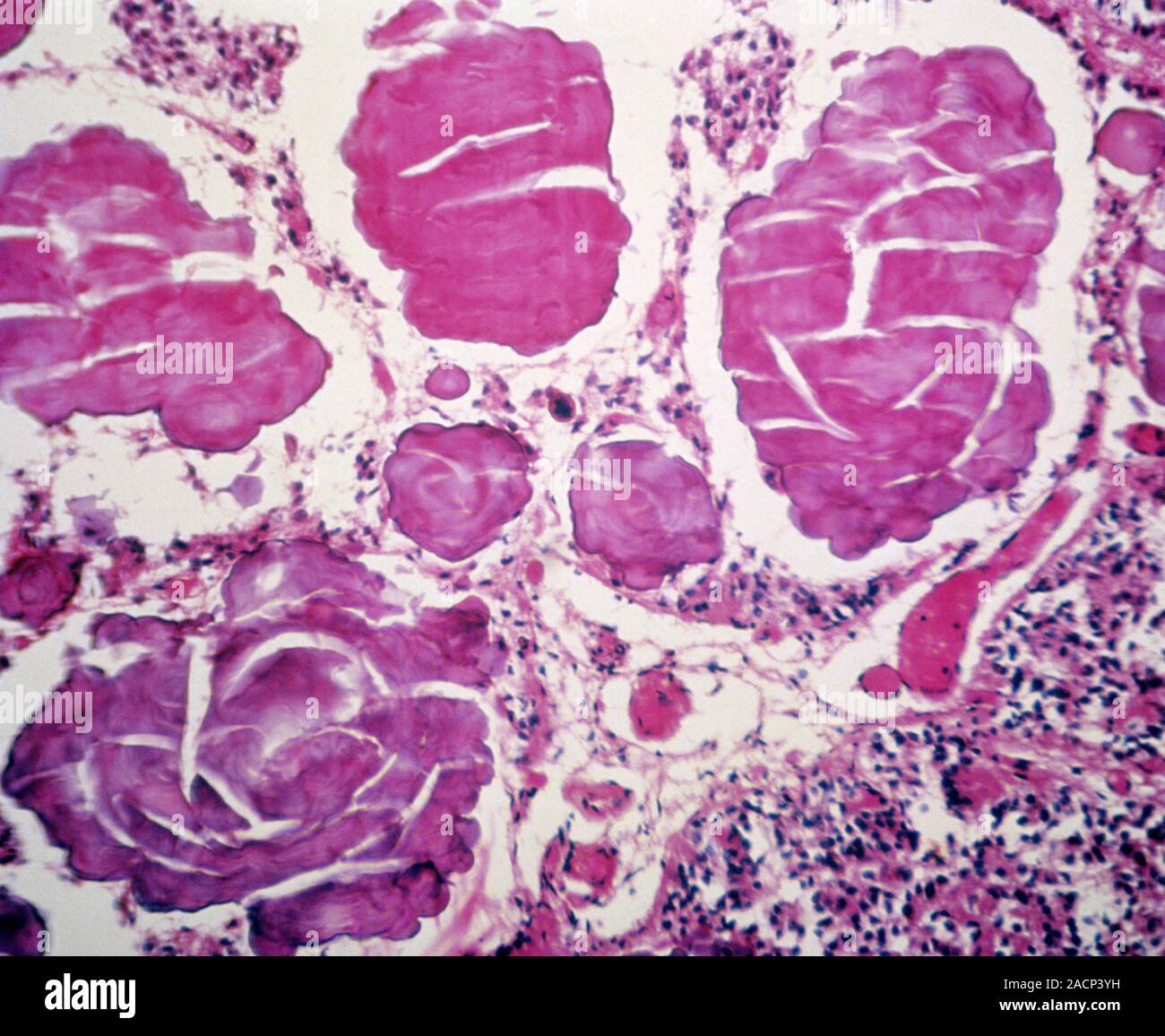 Pineal gland, light micrograph. The pineal gland is a small endocrine ...