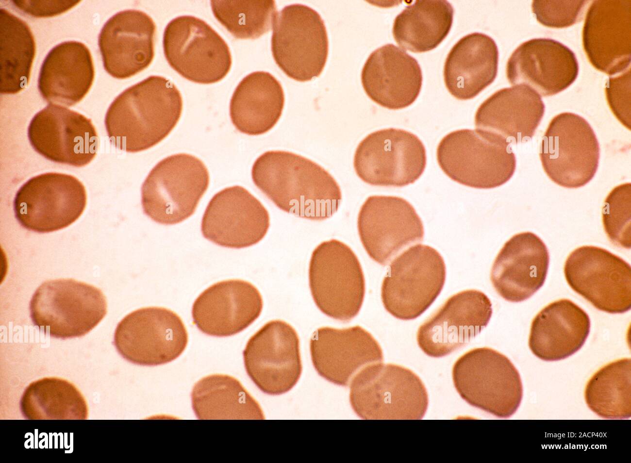 Elliptocytosis. Light micrograph of red blood cells in a case of ...