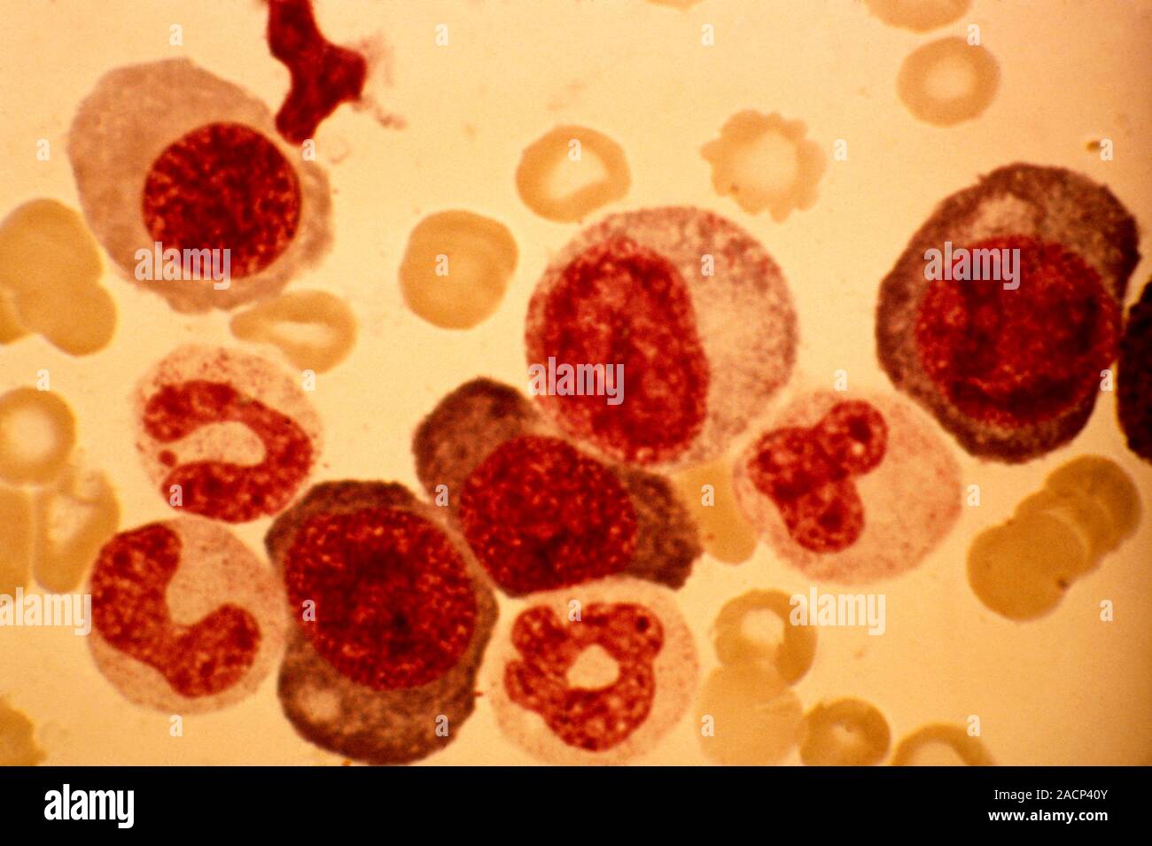 Pernicious anaemia. Light micrograph of megaloblast blood cells from ...
