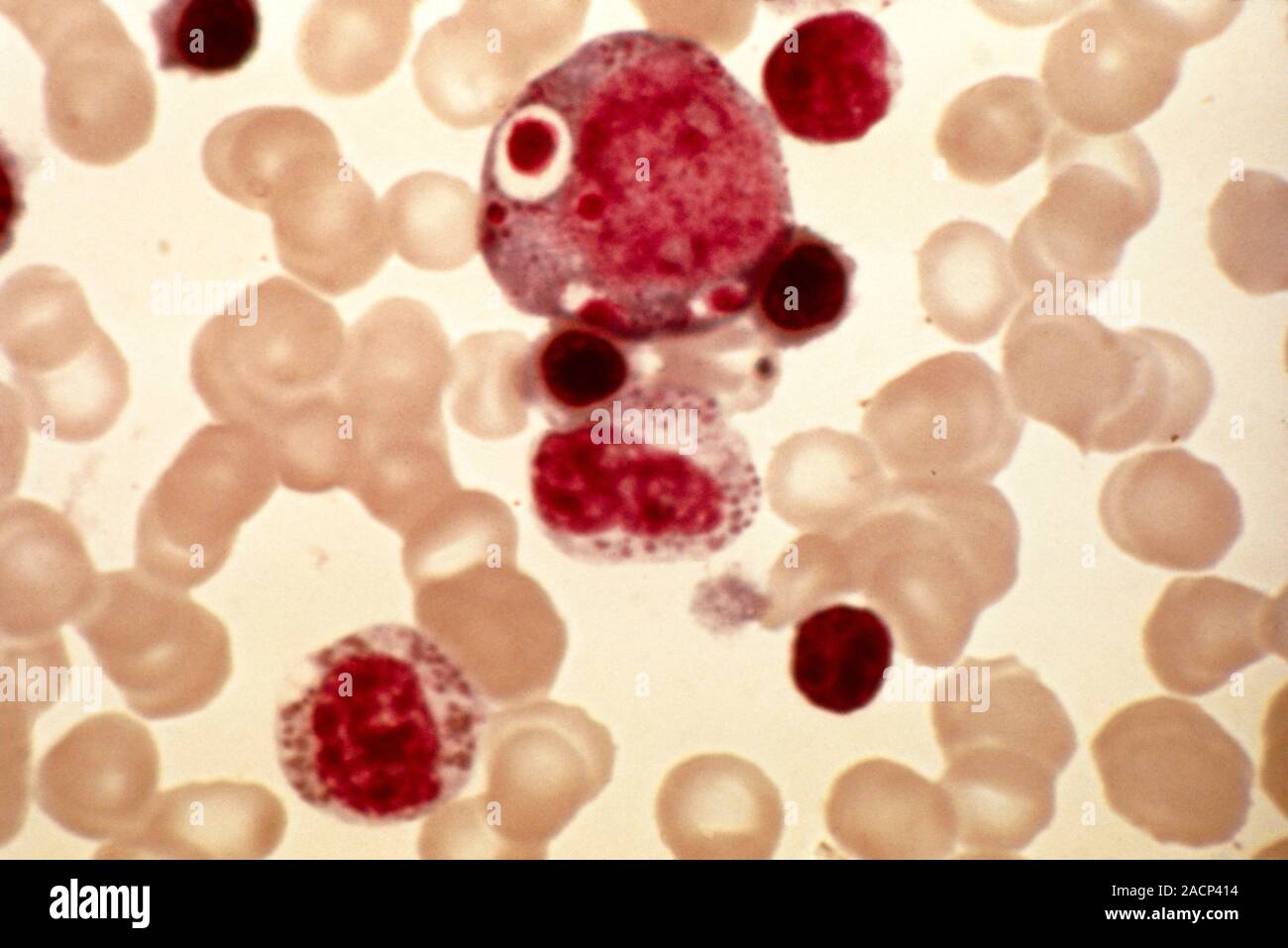 Chediak-Higashi syndrome. Light micrograph of blood cells in a case of ...