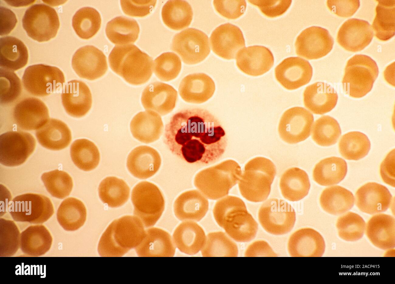 Dohle bodies in blood cell. Light micrograph of a neutrophil white ...
