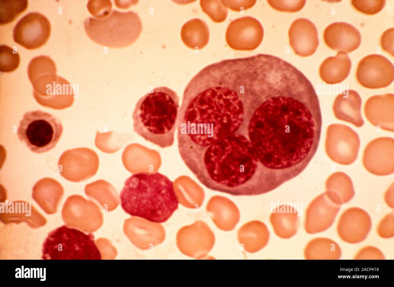 Acute erythroid leukaemia. Light micrograph of blood cells from bone ...