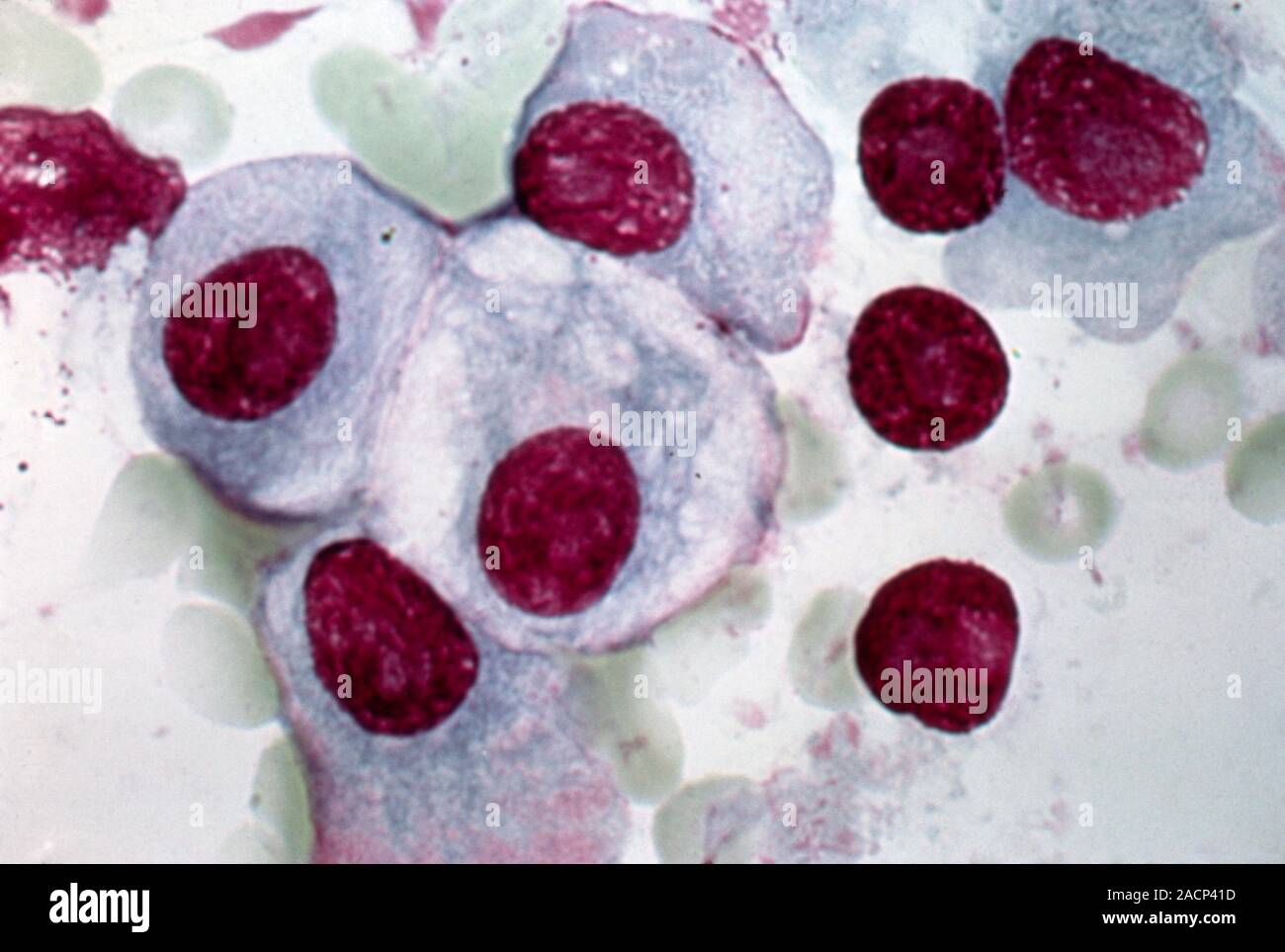 Multiple myeloma. Light micrograph of a group of dystrophic (abnormal ...