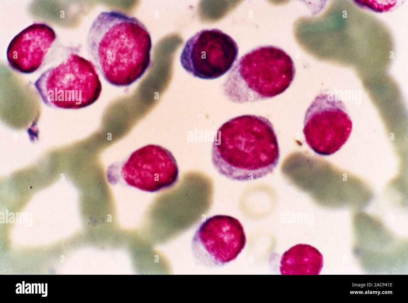Multiple myeloma. Light micrograph of a group of plasmoblasts ...