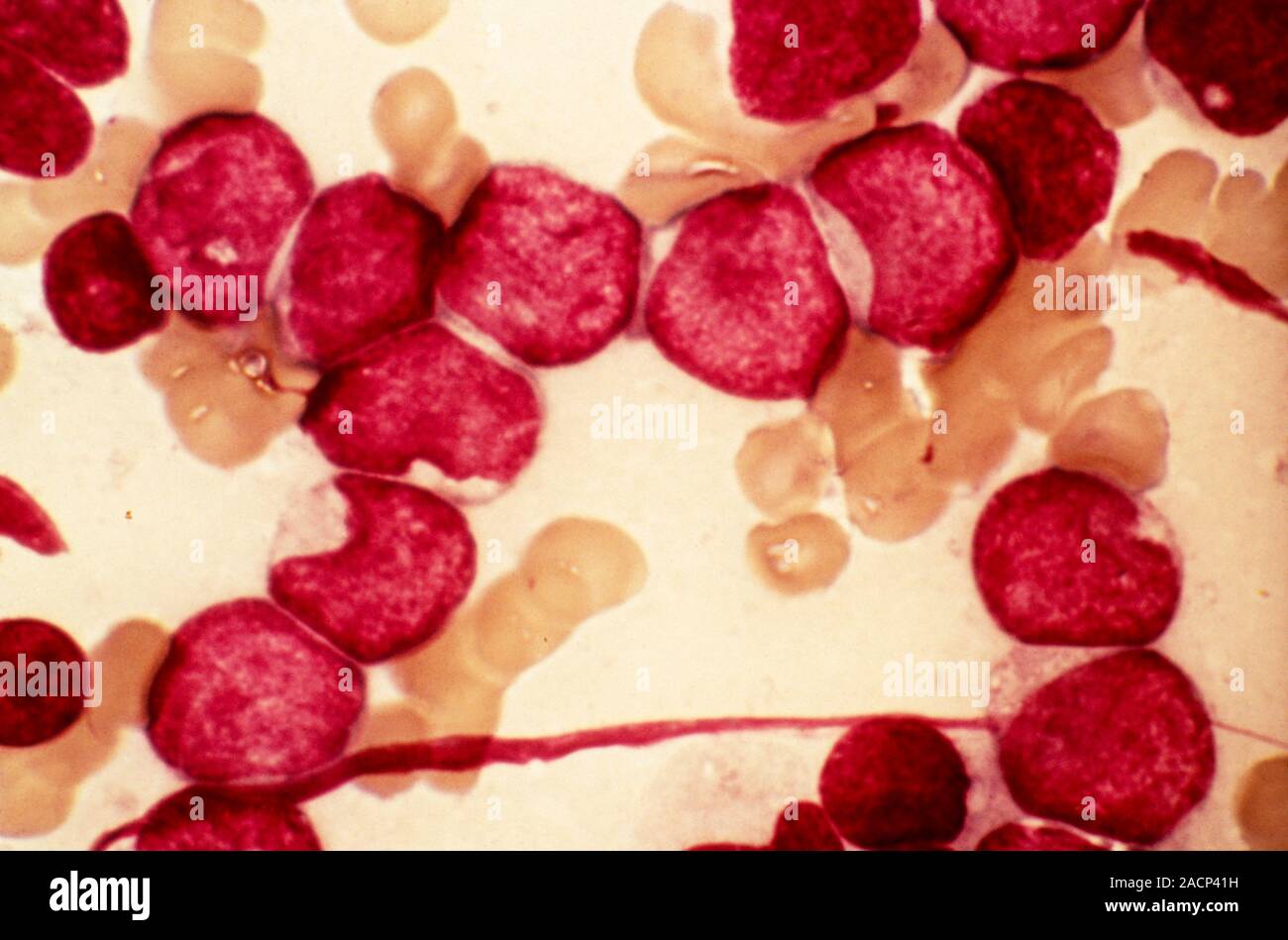 Acute myeloid leukaemia. Light micrograph of blood cells from bone ...