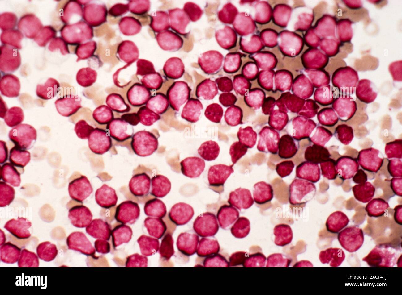 Acute lymphoblastic leukaemia. Light micrograph of blood cells from ...