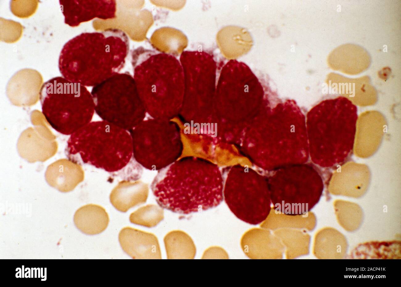 Acute lymphoblastic leukaemia. Light micrograph of blood cells from ...