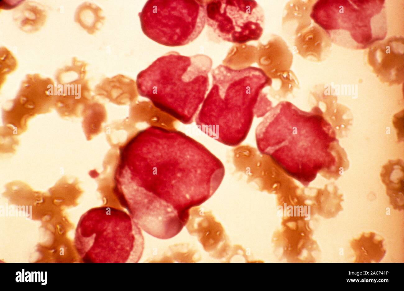Acute myeloid leukaemia. Light micrograph of blood cells from bone ...