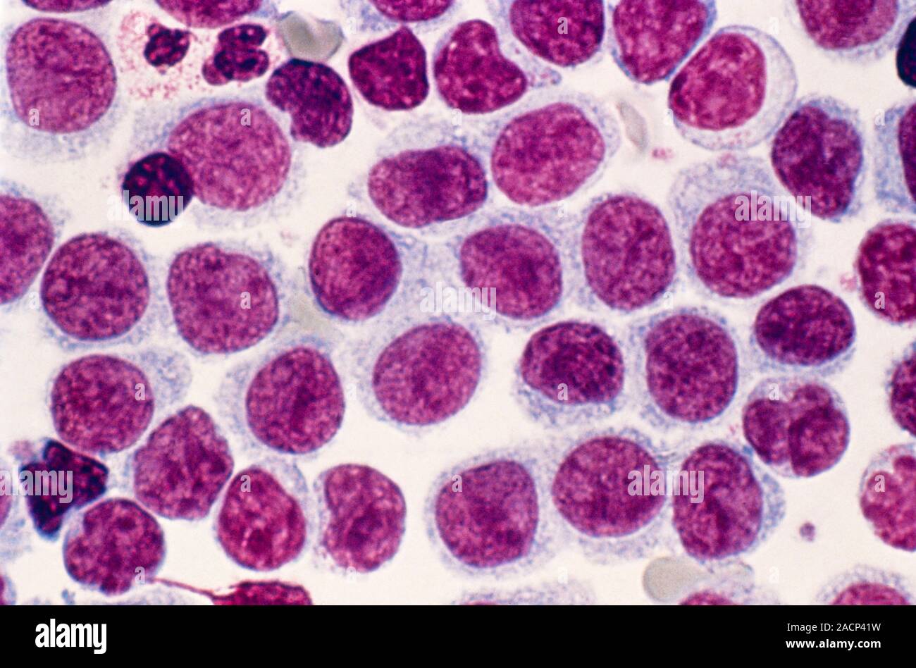 Hairy cell leukaemia. Light micrograph of blood cells in a case of ...