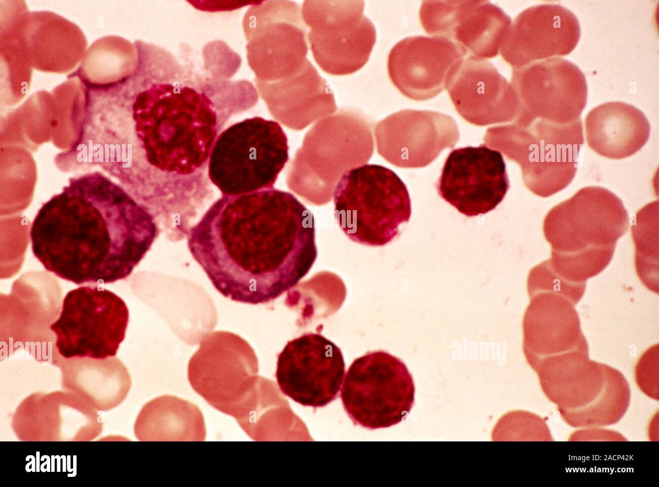 Lymphoplasmacytic lymphoma. Light micrograph of a mixture of small ...