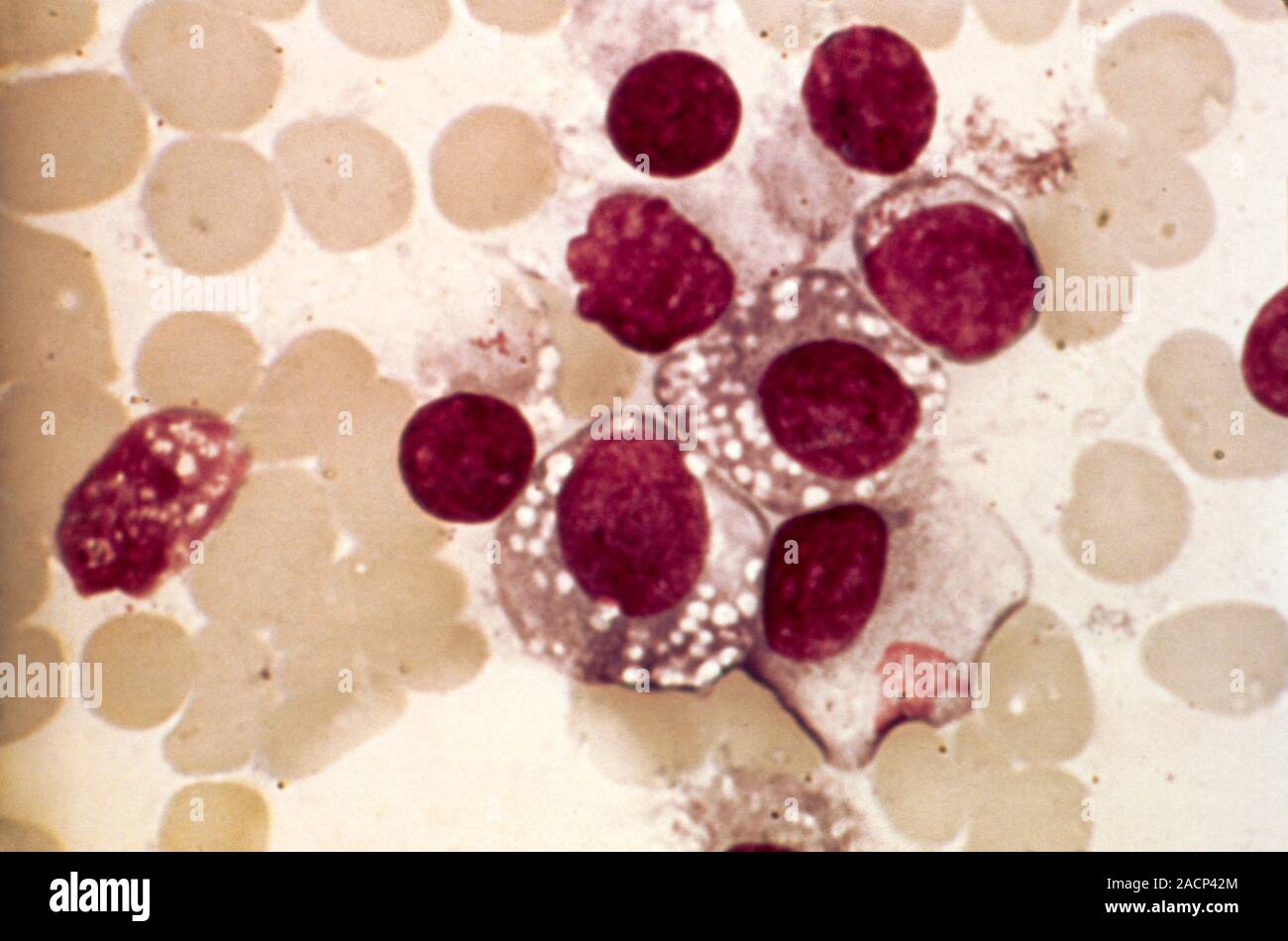 Lymphoplasmacytic lymphoma. Light micrograph of a mixture of ...