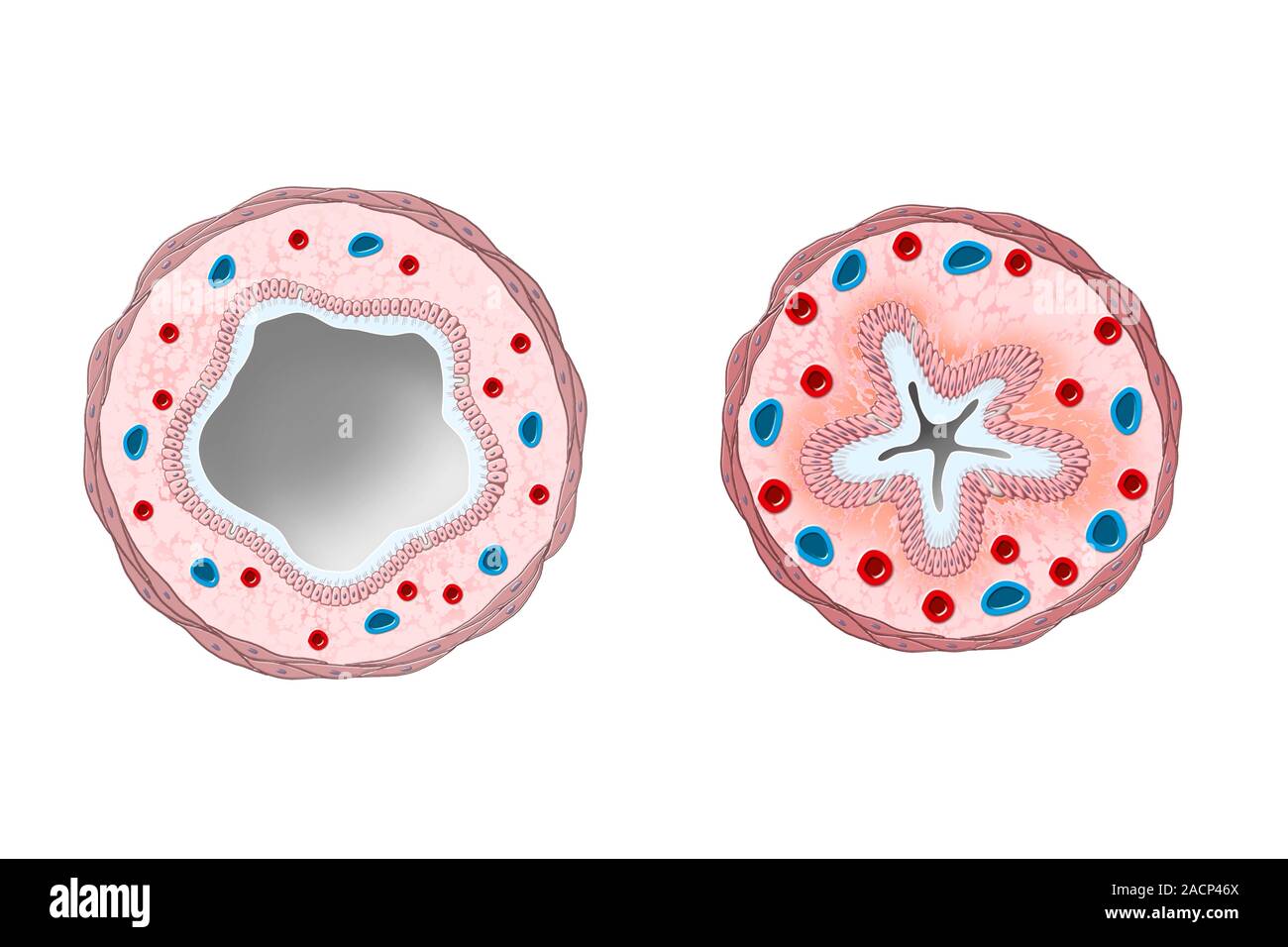 Healthy and constricted bronchi. Computer artwork of a cross-section ...
