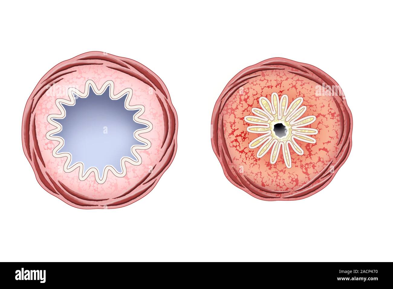 Healthy and constricted trachea. Computer artwork of a cross-section ...