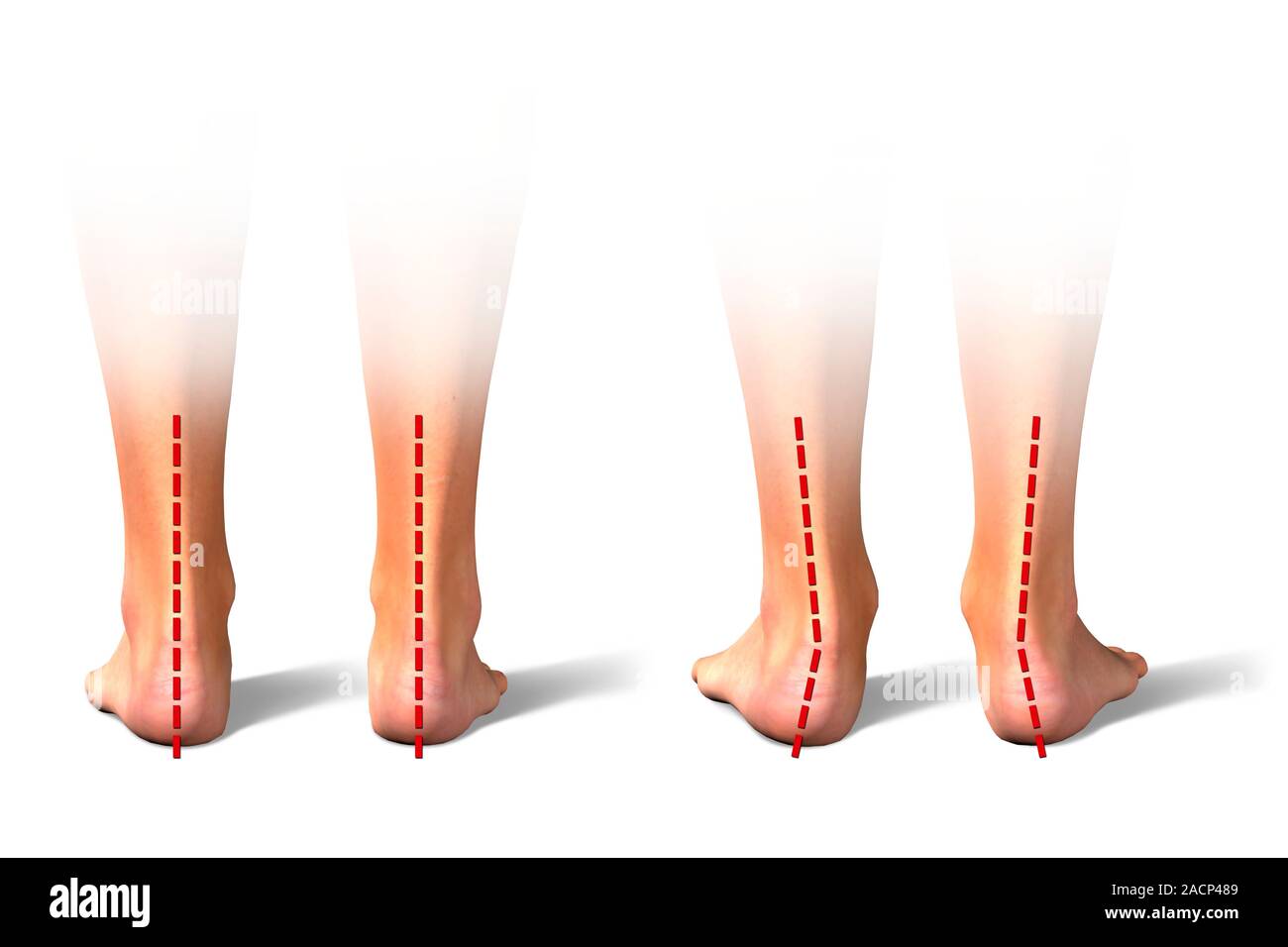 Pronation of the feet. Computer artwork showing the normal position of ...