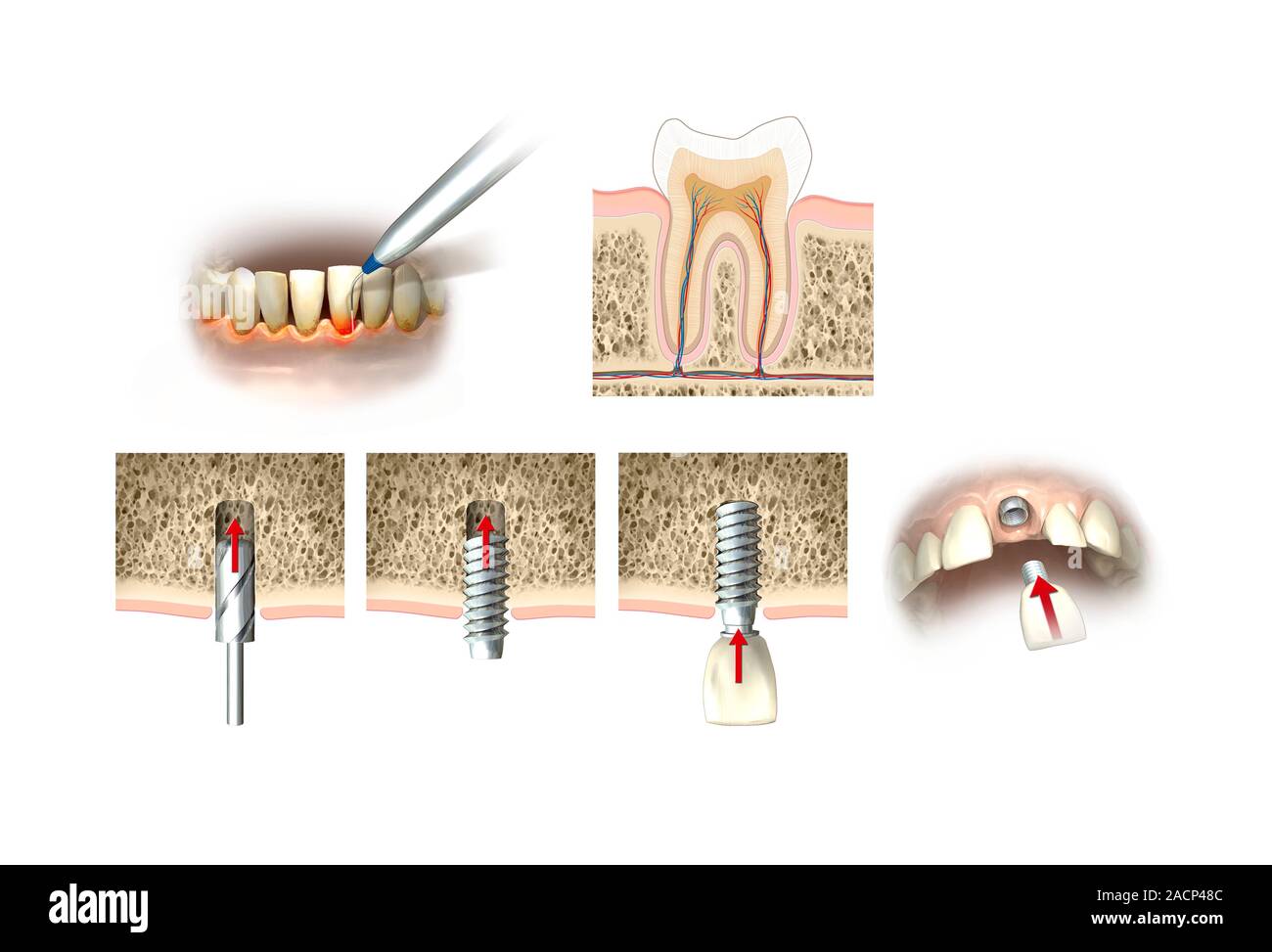 Dental implant. Artworks showing the process of replacing a tooth ...