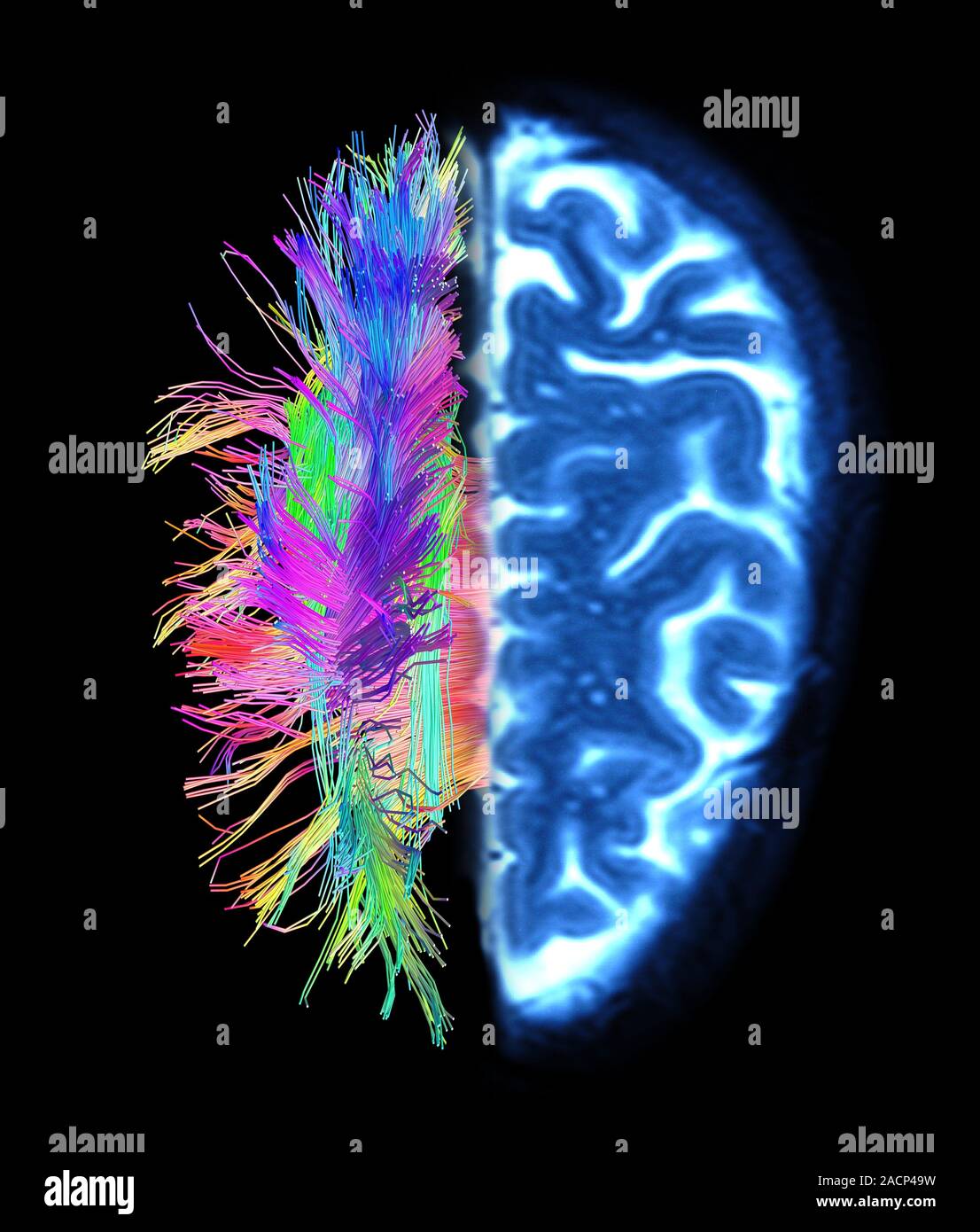 White matter fibres overlaid a 3d model of the human brain in top view ...