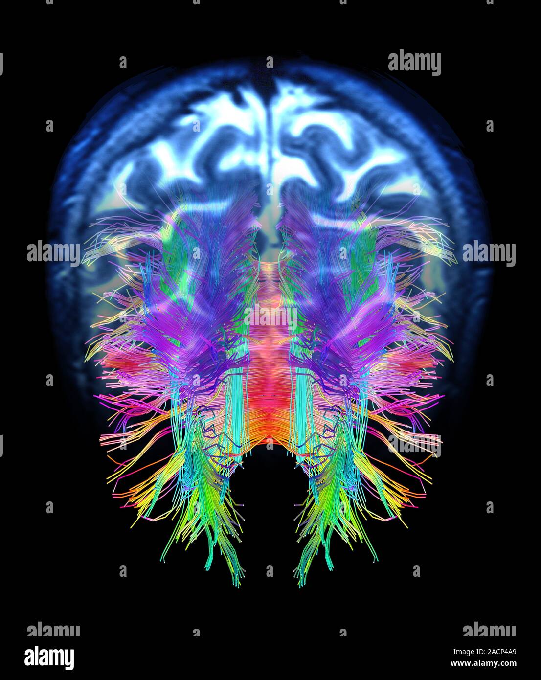 White matter fibres overlaid a 3d model of the human brain in top view. Coloured 3D diffusion ...
