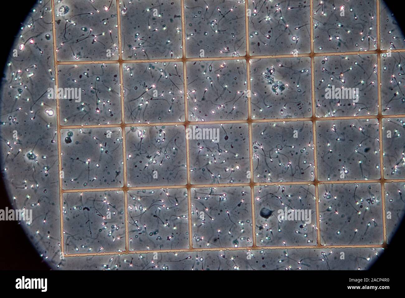Sperm bank sample. Sperm sample seen through a microscope lens. This is ...