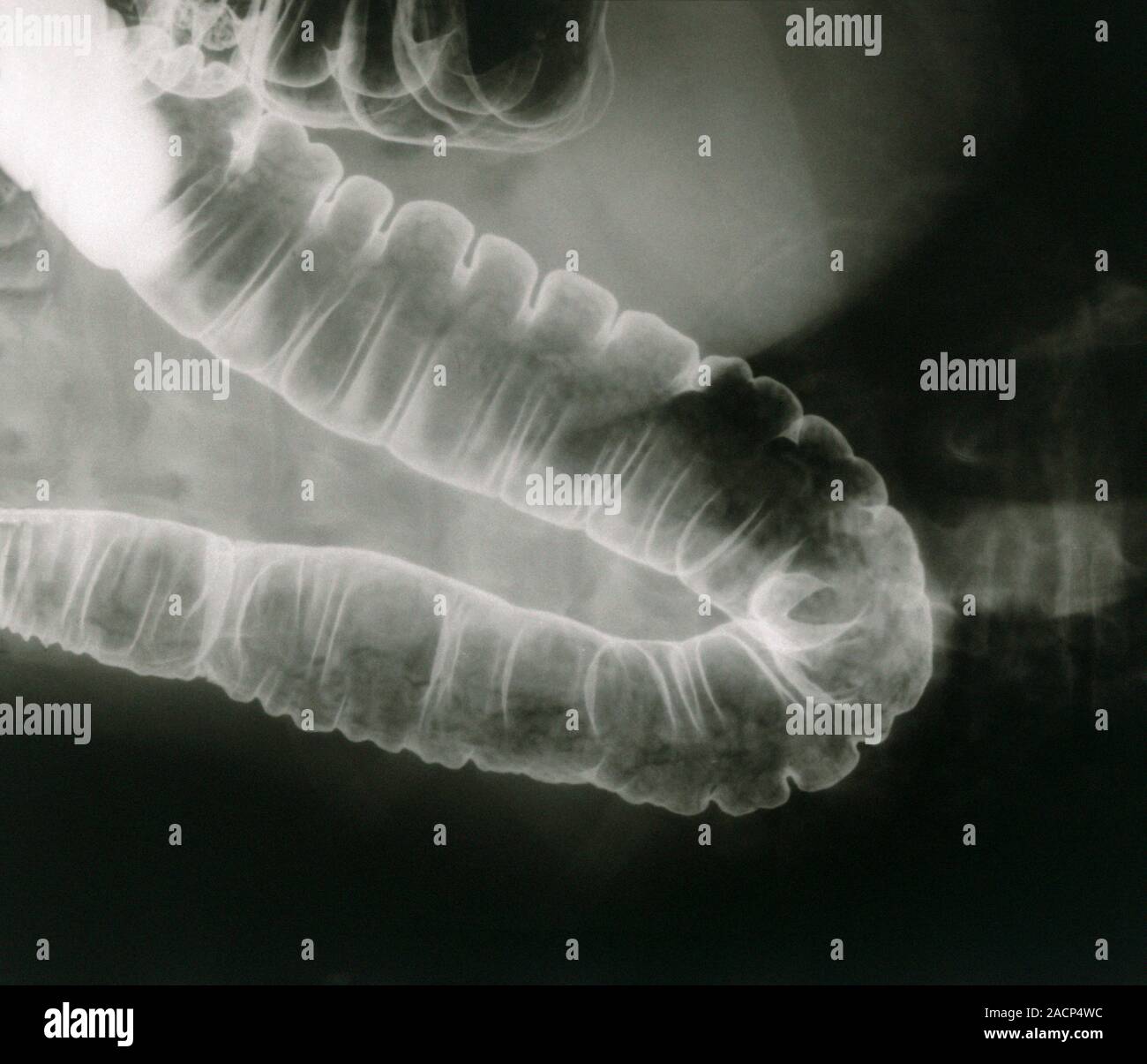Large intestine. Double contrast coloured X-ray of the abdomen showing ...